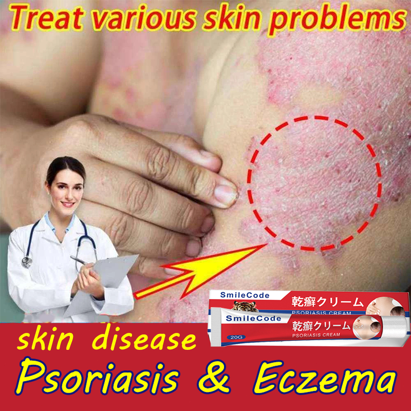Psoriasis eczema treatment cream20g dermovate fungi allergy cream ...