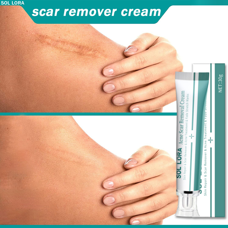 SOL LORA Scar Remover for Old Scar On Leg Stretch Mark Remover Scar Gel ...