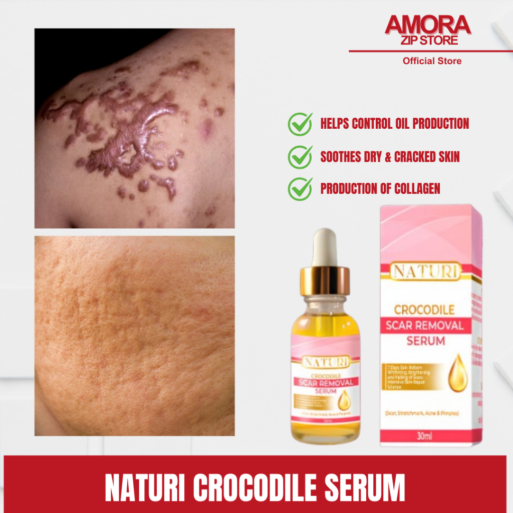 Amora Zip Naturi Crocodile Scar Removal Serum 30ml: 100% Effective Scar ...