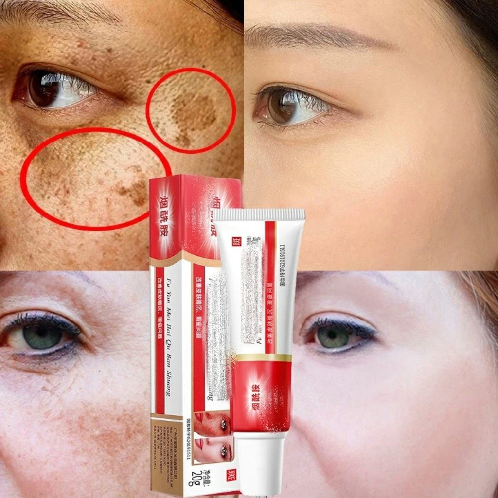 Melasma Remover Cream for Pekas & Dark Spots – Whitening & Collagen Set ...