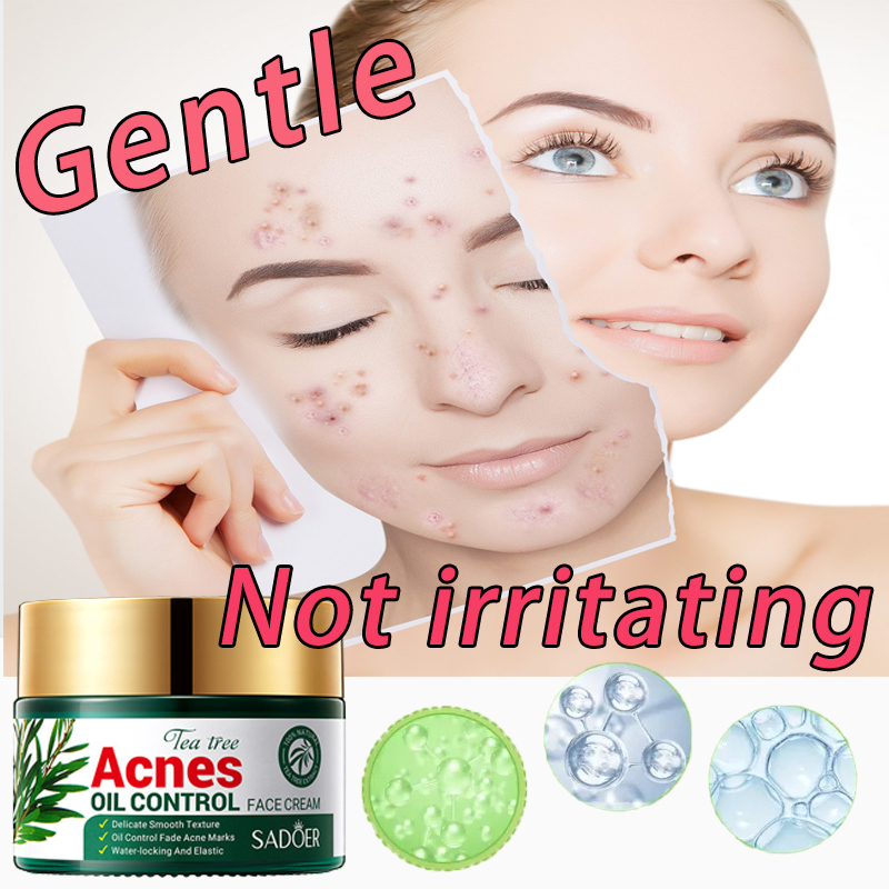 Anti-acne Cream is delicate and smooth fades acne marks elastic and ...