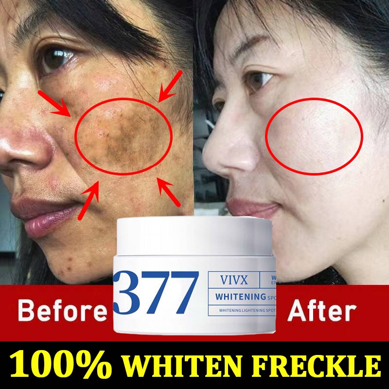 377 Whitening Cream Melasma Whitening Nicotinamide Freckle Cream Dark ...