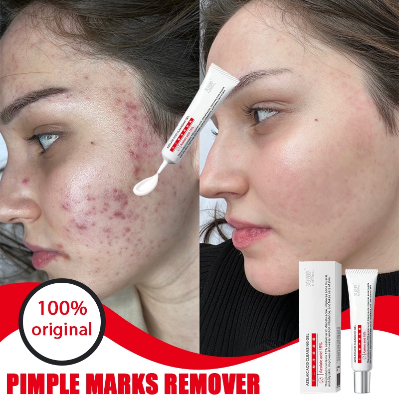 Acne treatment pimple marks remover acne scar remover acne spot ...