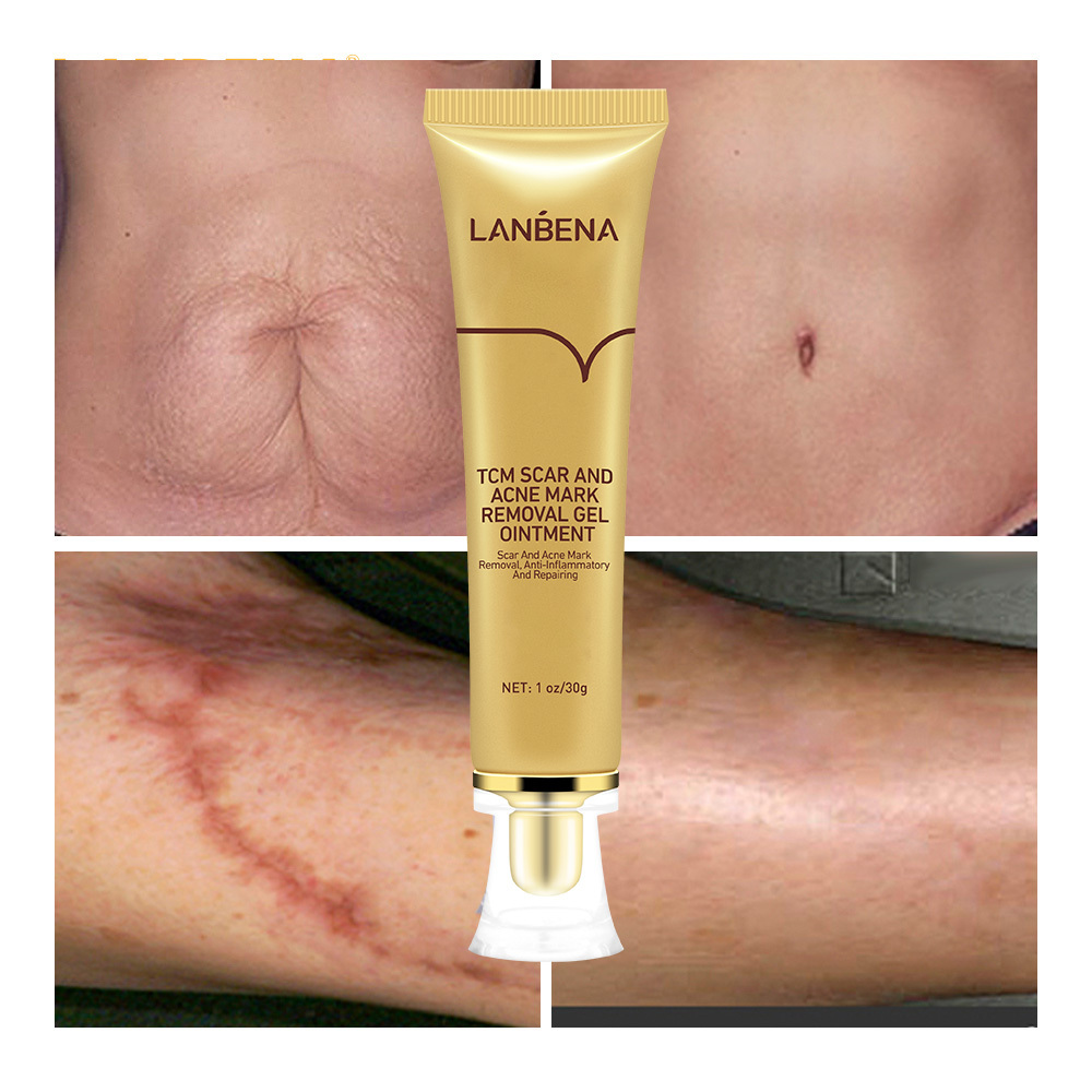 LANBENA Original TCM Acne Spots Scar Removal Cream Blackhead Pimple ...