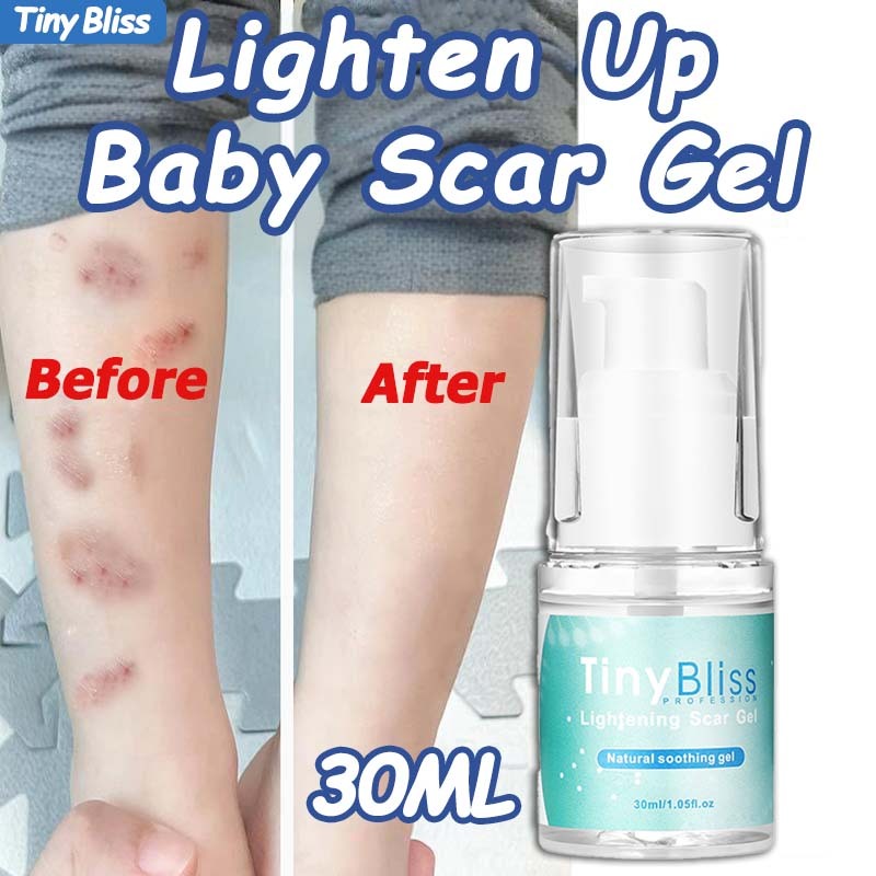 TinyBliss Lighten Up Lightening Baby Scar Remover Cream For Kids ...