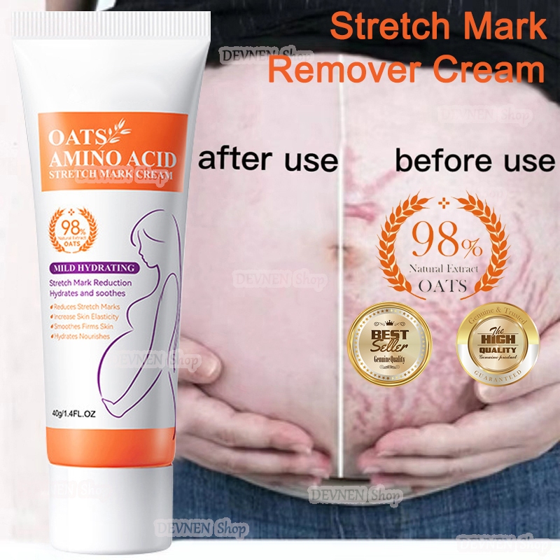 Stretch Mark Remover Cream Oats Amino Acid Safe&Effective Remove ...
