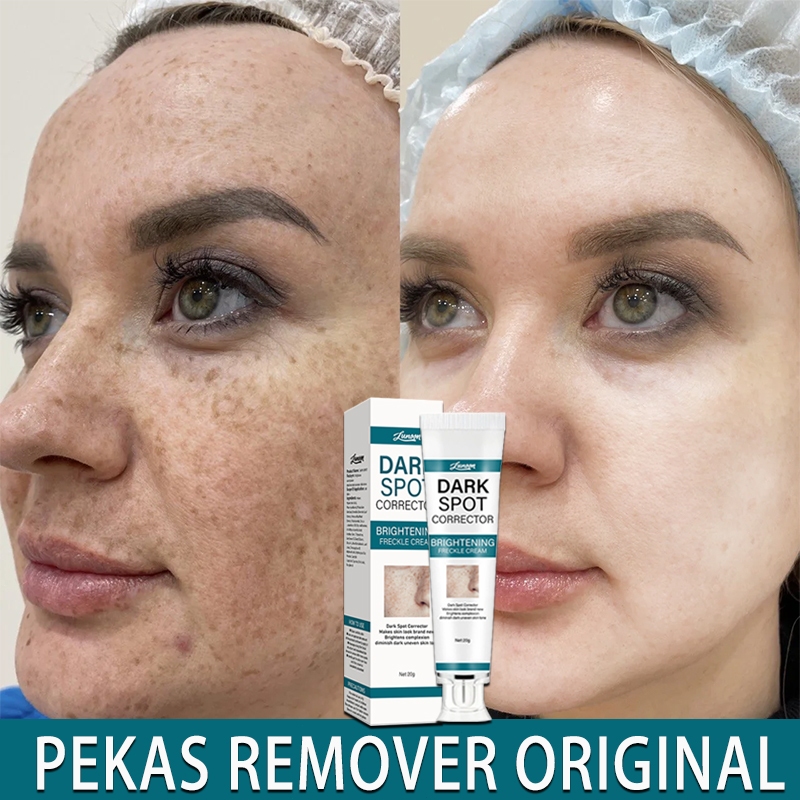Melasma cream remover whitening cream for face cream for melasma dark ...