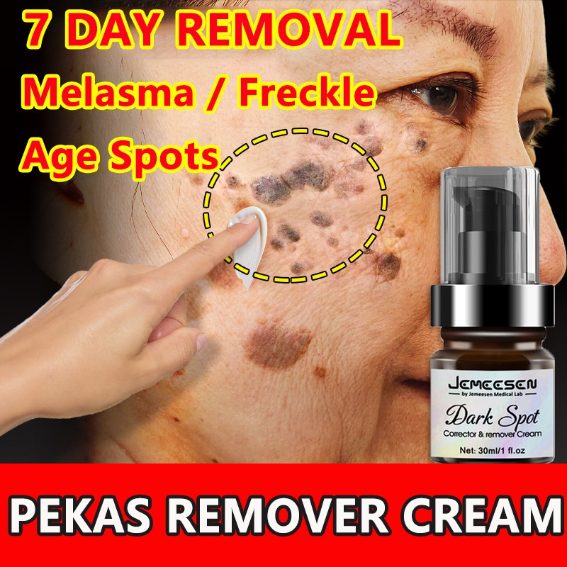 Melasma Remover Pekas Cream Original Remove Freckles Face Whitening ...