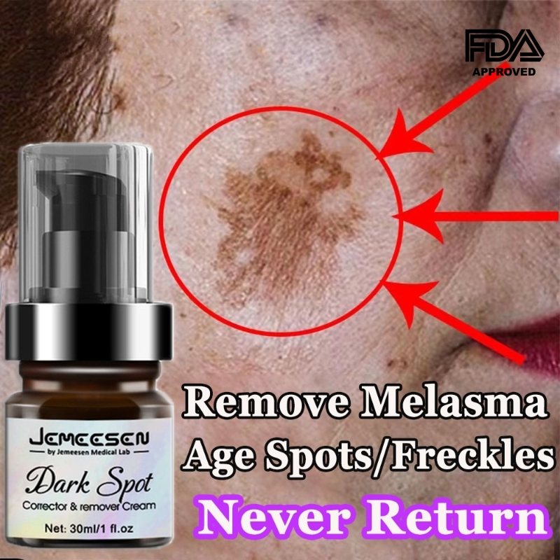 Melasma Remover Cream Whitening Freckles Cream Pekas Removal Anti Dark ...