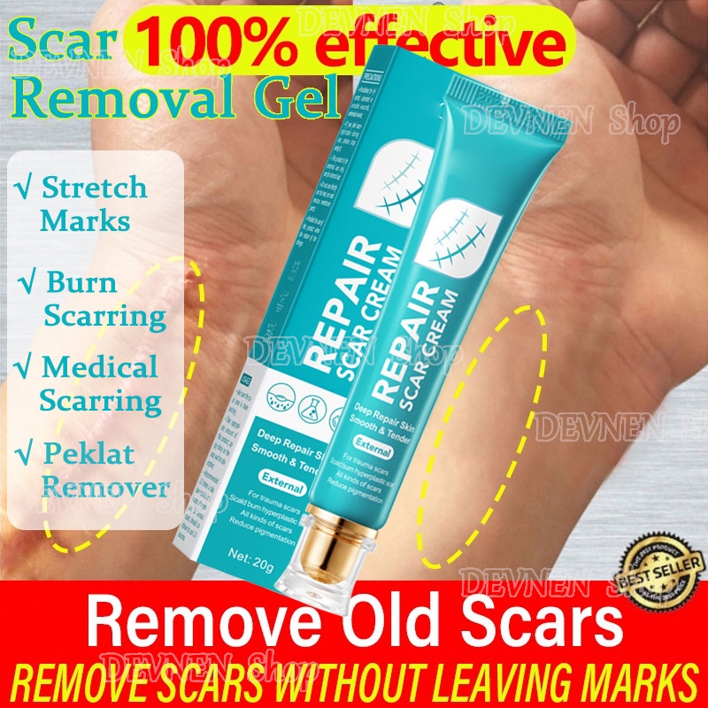 Scar Remover Cream Stretch Mark Peklat Remover Old Scar On Leg Remove ...