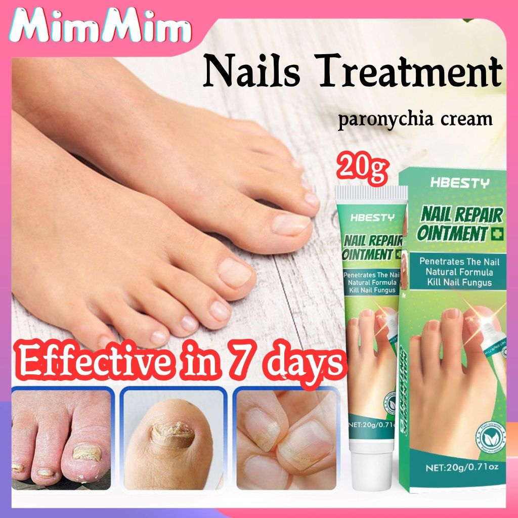 Nail Treatment Paronychia Remove cream Fungal Onychomycosis Nail Repair ...