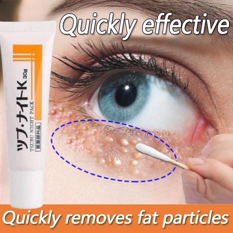 Milia Removal Cream Original Fat Granules Removal Eye Cream Warts ...