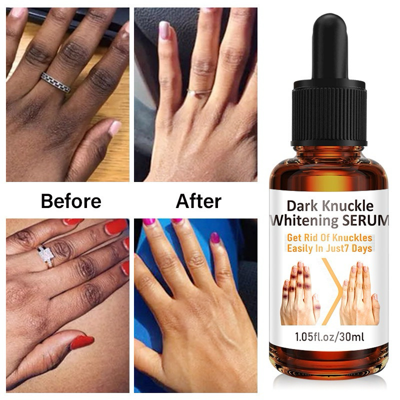 Dark knuckles Whitening Serum 30ml | Shopee Philippines