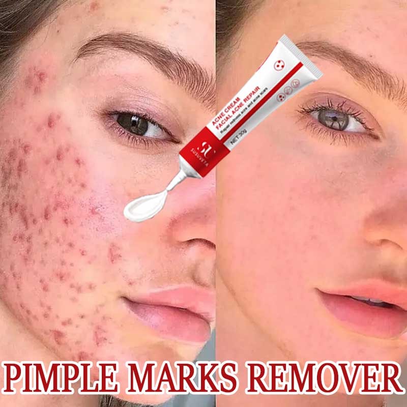 Acne treatment acne cream acne remover pores remover pimple remover ...