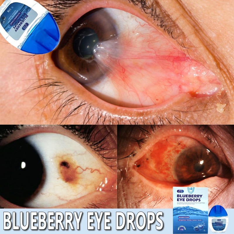 Blueberry eye drops original | Cataract | Dry eyes | Pterygium | Itchy ...