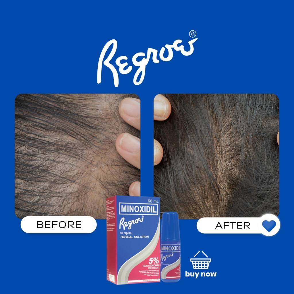 Regroe Minoxidil 5% 120mL | Shopee Philippines