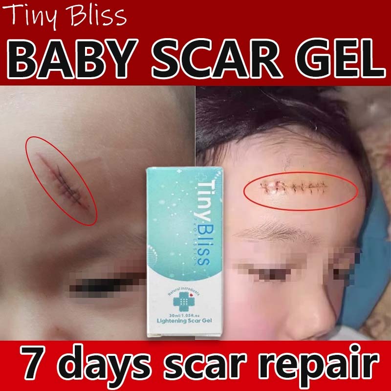 TinyBliss Baby Scar Gel Scar Remover Cream For Kids Lighten Up ...