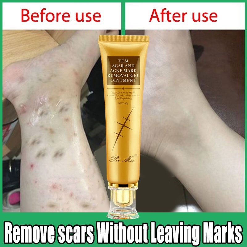 Scar Remover Cream Old Scar Acne Mark Remover Acne Scar Gel Face and ...