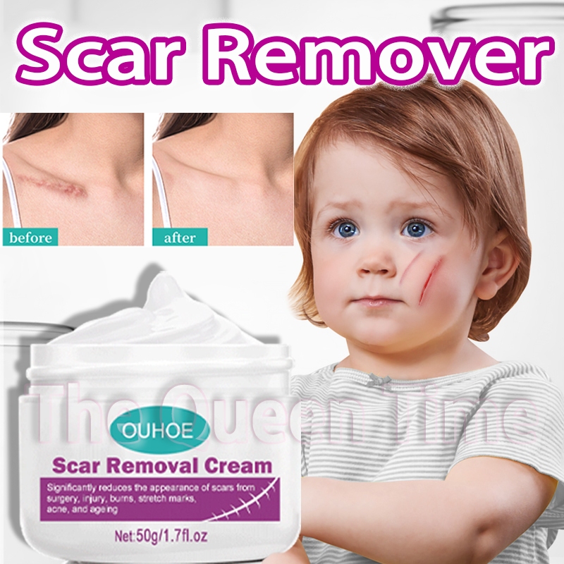 50G Scar Removal Cream Old Scar Peklat Remover Acne Treatment Remover ...