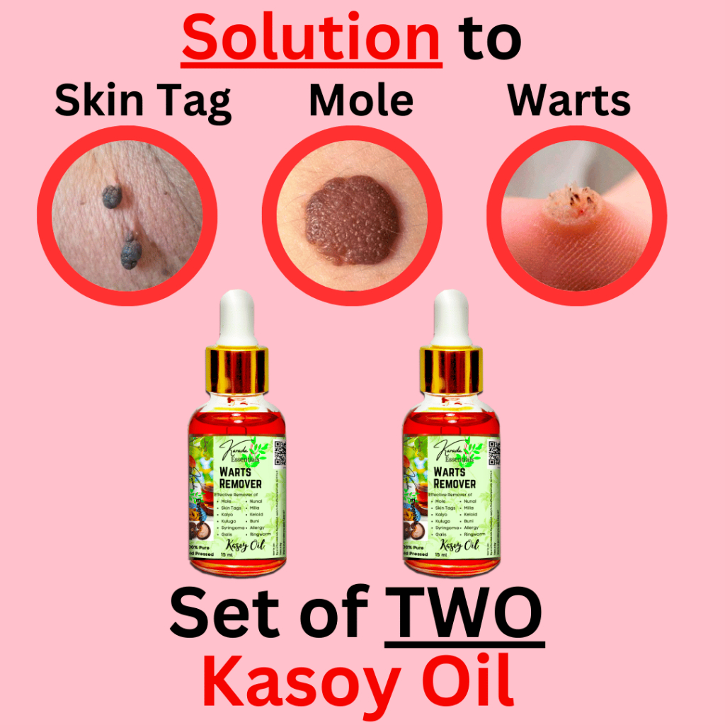Pure Kasoy Oil: Fast & Effective Wart, Skin Tag, Nunal, Kulugo Remover ...