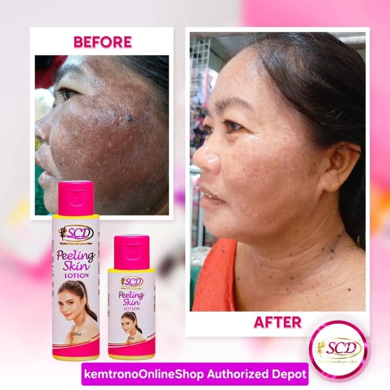 SCD Skin Peeling Lotion Original 50ml and 100ml sizes | Shopee Philippines