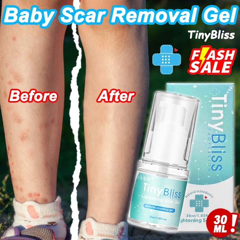 TinyBliss Lighten Up 30ml Lightening Scar Gel Baby Scar Remover Dilute ...