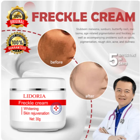 pekas remover cream original melasma remover from japan melasma and ...