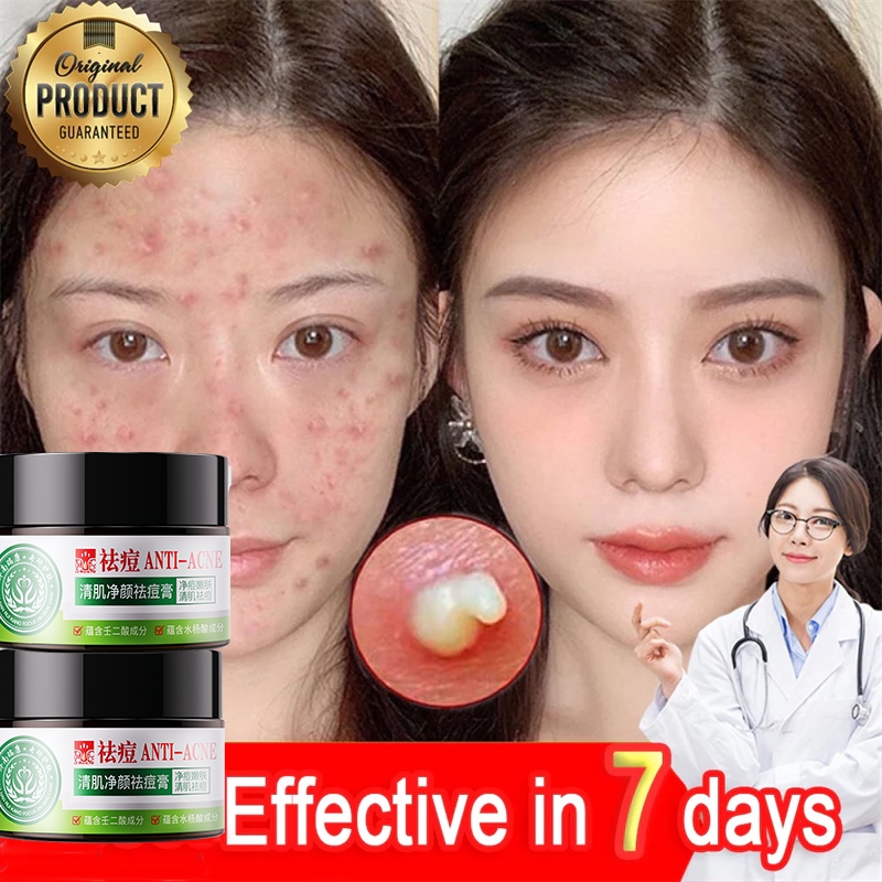 Acne Cream Remover Blackheads Treatment pimples Lightens acne marks ...