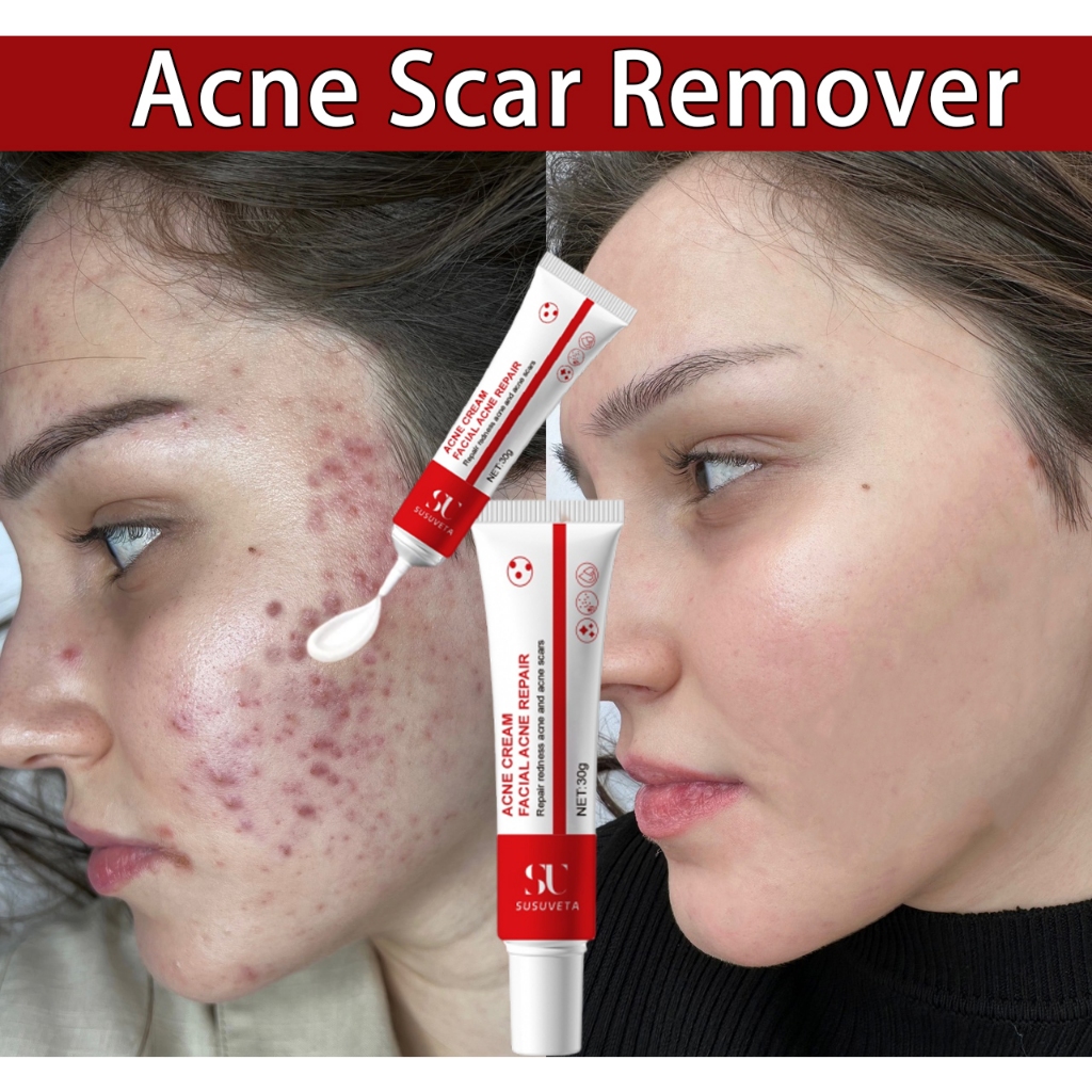Pimple remover acne remover pimple marks remover anti acne and pimples ...