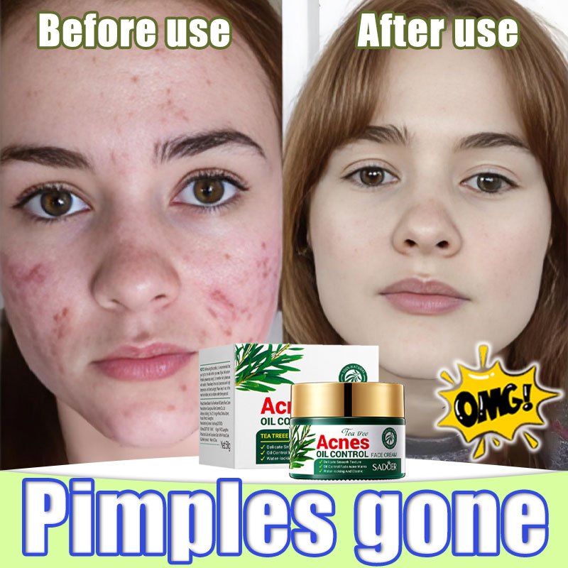 Tea Tree Pimple Acne Remover for acne and pimples 100% Effective fast ...