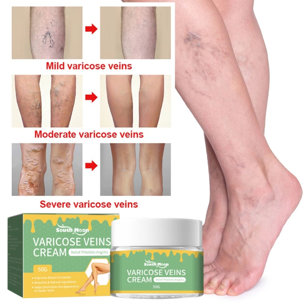 Varicose Vein Remover Spider Vein Pain Killer Cream ORIGINAL Effective ...