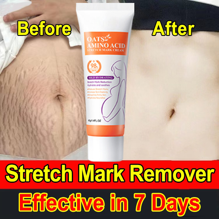 Anti Stretch Mark Remover Cream Scar Remover Cream Firming Skin Cream ...
