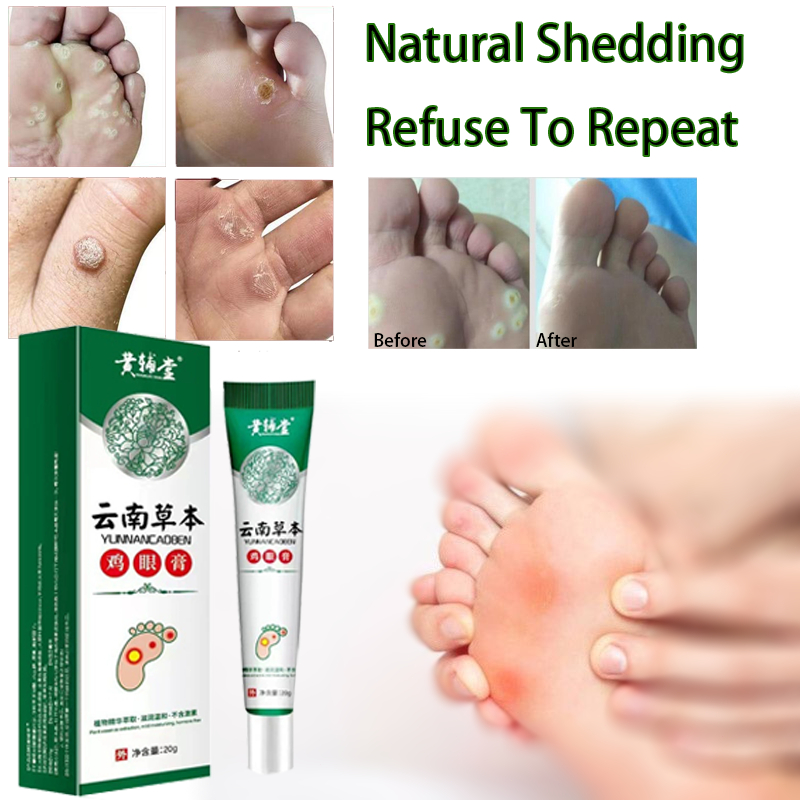 【COD】Callus & Wart Remover Cream for Verruca Corns Callus Elimination ...