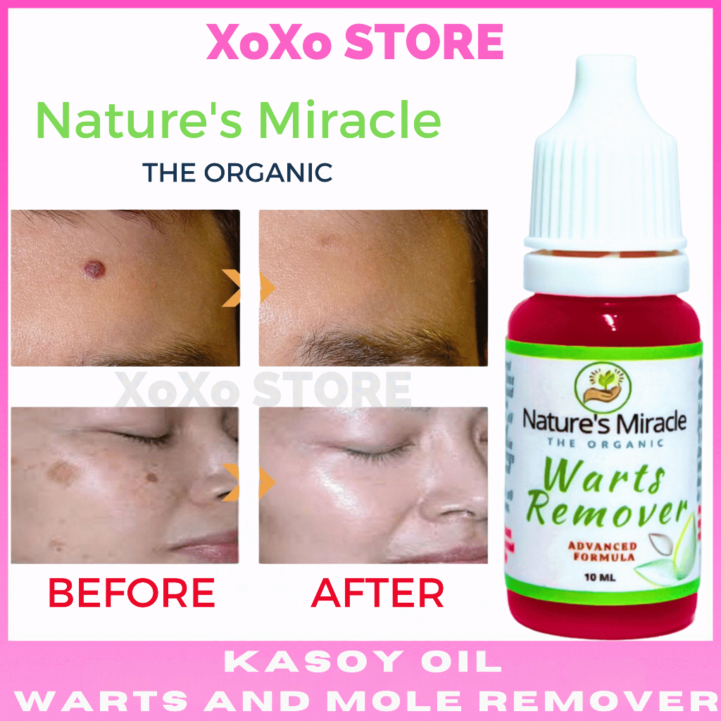 Kasoy Oil Original Wart Removal – Nature’s Miracle Warts & Skin Tag ...