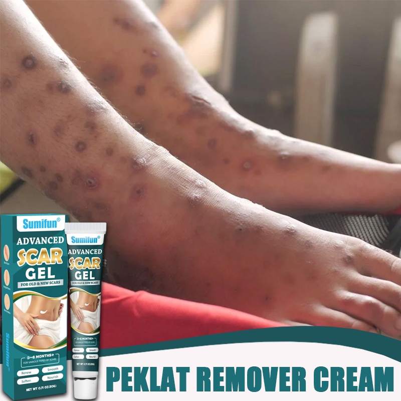 Peklat remover cream pampawala ng peklat original scar cream removal ...