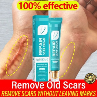Scar Remover Cream For Old Scar On Leg Scars Remove Pregnancy Scar ...