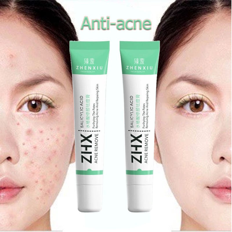 Salicylic Acid Acne Treatment Ointment Pimple Remover Skin Care Acne ...