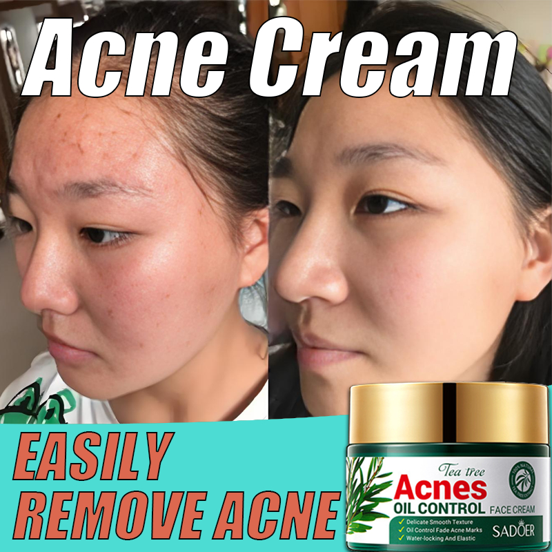 Acne Cream acne treatment Improve facial skin texture remove acne and ...