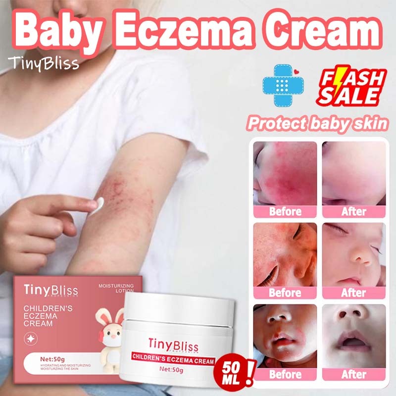 TinyBliss50g Antiseptic Baby Eczema cream Relief Rashes&Diaper Rash ...