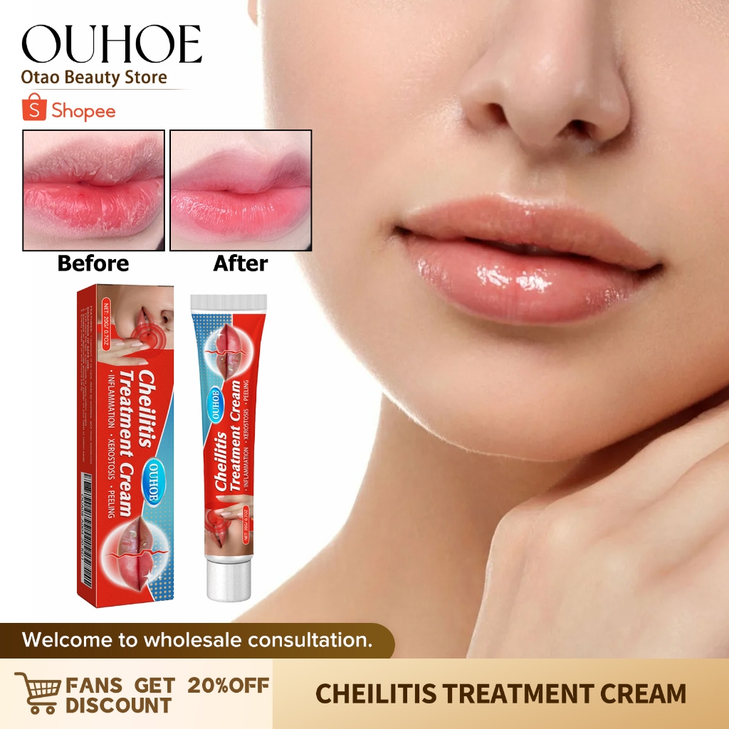 OUHOE Cheilitis Treatment Cream 20g Cold Sore Antibacterial Ointment ...