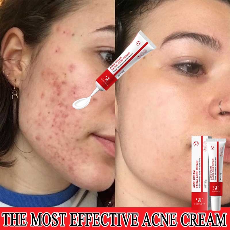 Acne cream anti acne acne remover acne treatment pimple marks remover ...