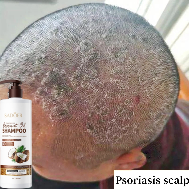 Psoriasis shampoo Coconut oil shampoo Anti dandruff itchy scalp ...