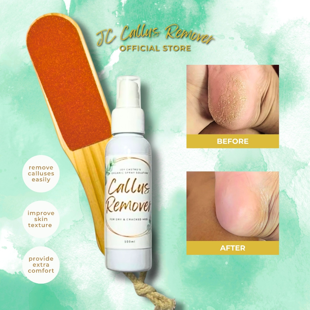 JC Callus Remover Organic Spray Solution with Foot File | Shopee ...