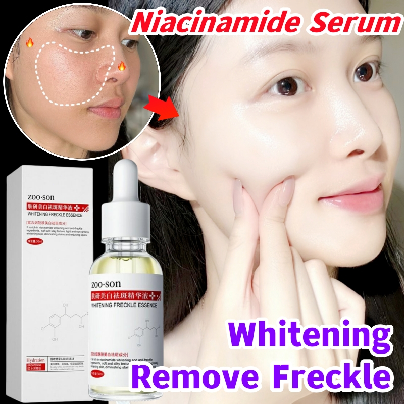 60ml Pekas Remover Serum For Melasma And Dark spot Melasma Serum Pekas ...