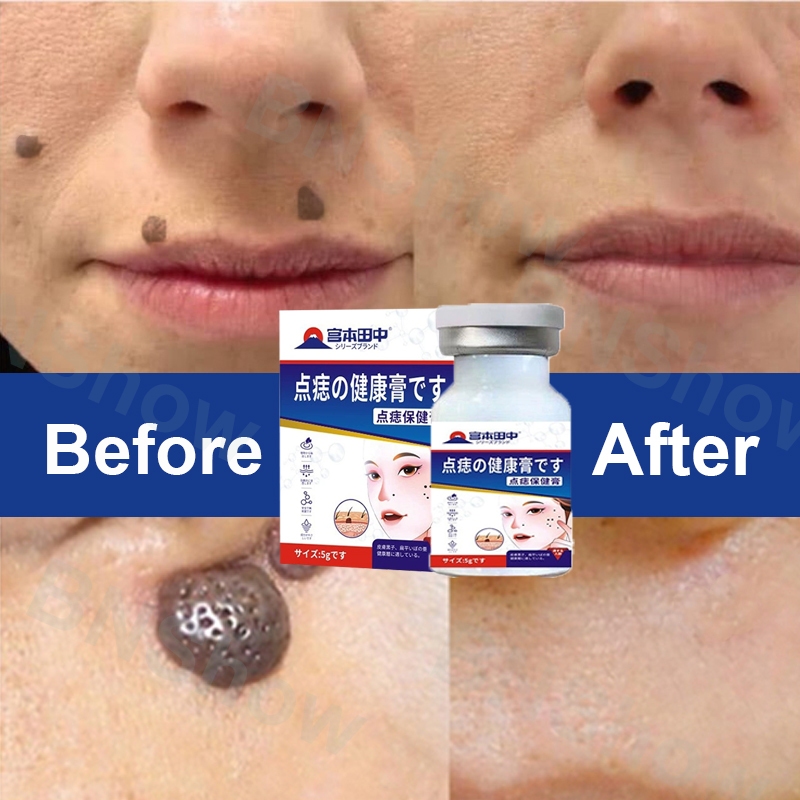 Japan mole removal cream warts remover Skin tag remover painless no ...