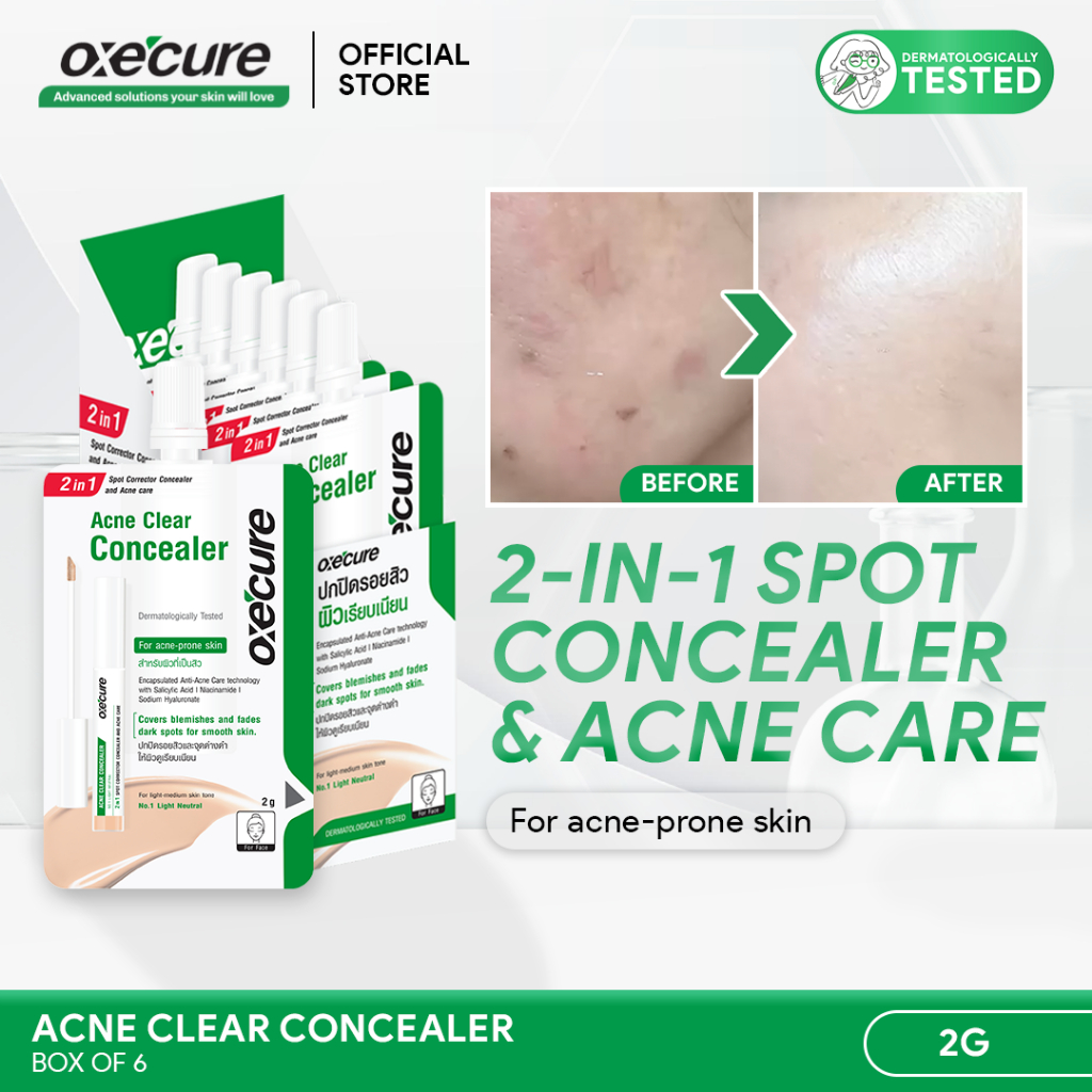 Oxecure ACNE CLEAR CONCEALER 2G Bundle of 6 | Shopee Philippines