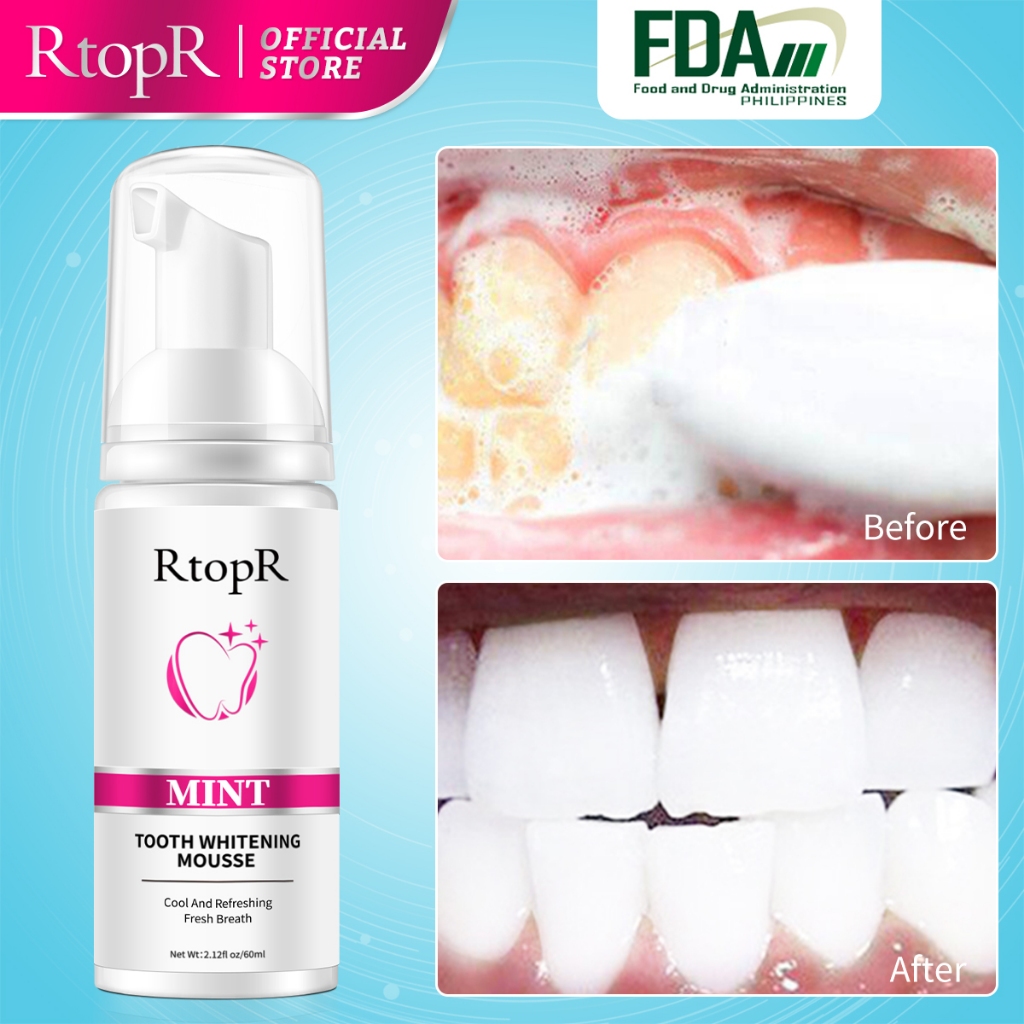 RtopR Teeth Whitening Mousse Remove Tartar Plaque Teeth Cleaning ...
