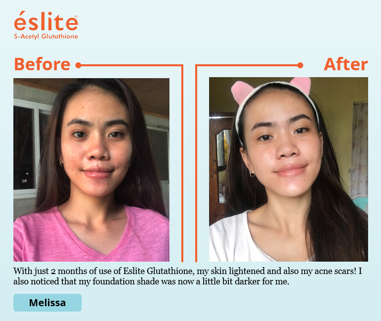 [OFFICIAL] Eslite S-Acetyl Glutathione (Anti Aging and Skin Whitening ...