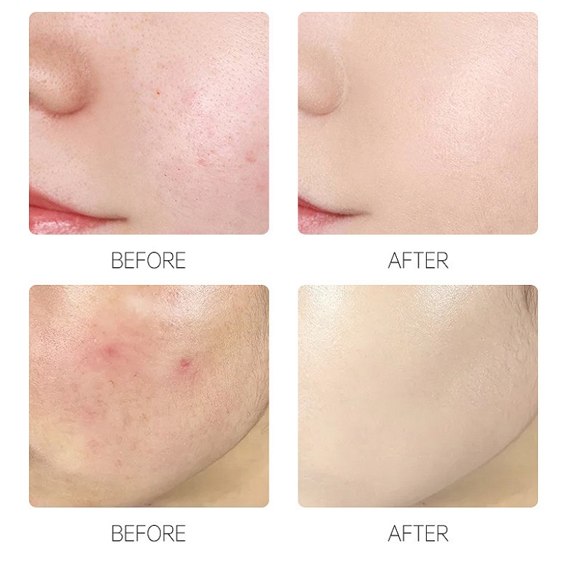 PINKFLASH 24 Hours Waterproof Invisible Ultra Thin Acne Patches for ...