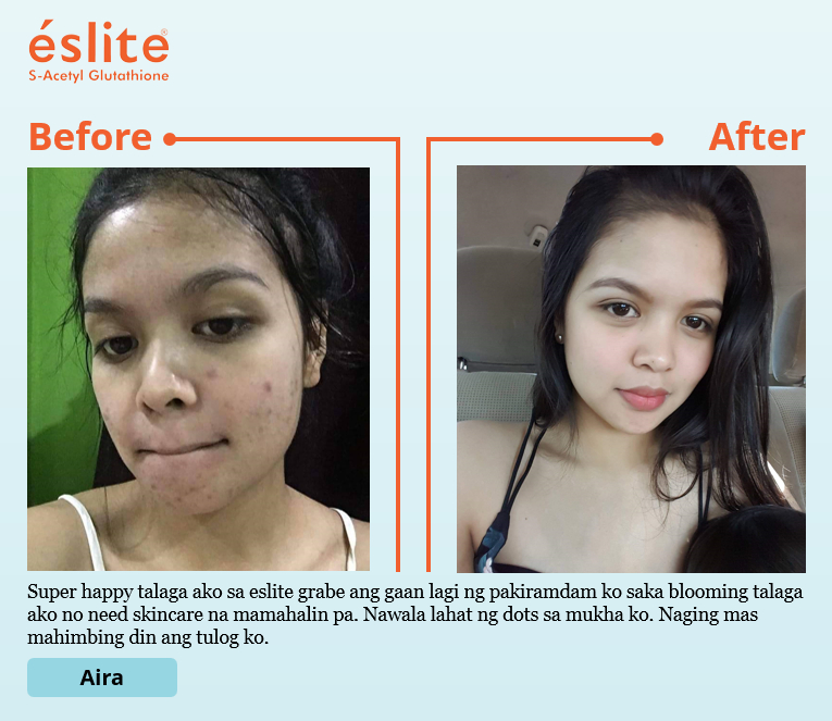 [OFFICIAL] Eslite S-Acetyl Glutathione (Anti Aging and Skin Whitening ...